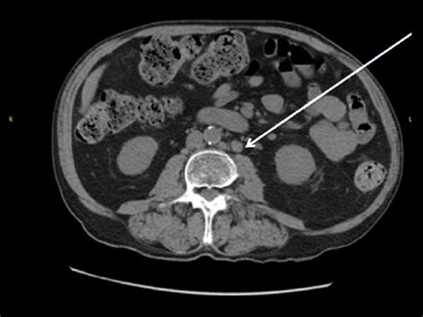 Aortic Lymph Nodes Location