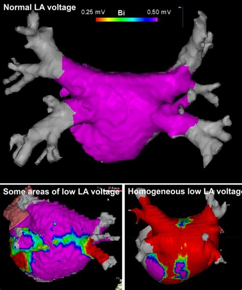 Examples Of Left Atrial Voltage Maps View Onto The Posterior Left Download Scientific Diagram