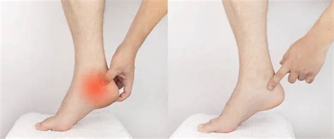 Bone Spurs In Foot Symptoms