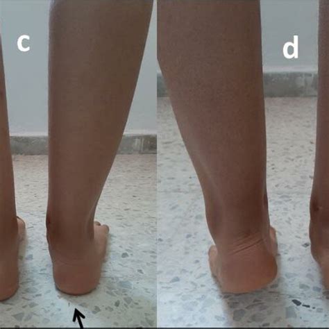 A Medial Arch Foot Collapse With Scare In Retromaleollae Ankle Download Scientific Diagram