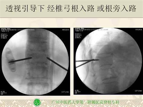 椎体成形中骨水泥充分填充的技巧及意义 好医术文章 好医术 赋能医生守护生命