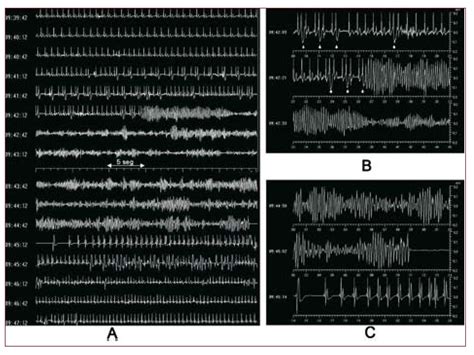 Long Duration Self Limiting Idiopathic Ventricular Fibrillation Revista Española De Cardiología