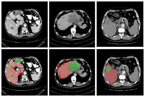 Examples Of Contrast Enhanced Ct Scans Showing Various Sizes Shapes Download Scientific