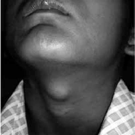 Technetium 99m Pertechnetate Thyroid Scan Showing Thyroid Ectopia Download Scientific Diagram