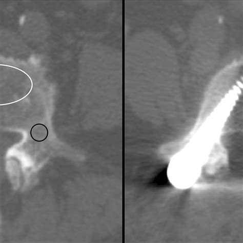 A 69 Year Old Female Underwent Dynesys Dynamic Stabilization Dds