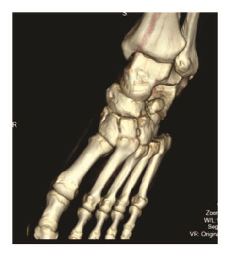 Ct Scan Demonstrating Dislocation Of Fourth And Fifth Tarsometatarsal Download Scientific