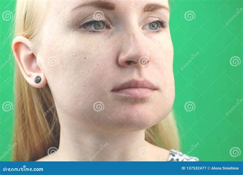 Tandenprobleem Abces Op Het Tandvlees Stroom En Het Zwellen Van De