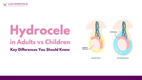 Hydrocelectomy Procedure Steps Types And Recovery Tips