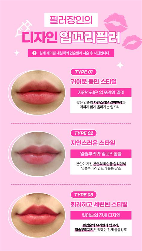 입꼬리필러and보톡스로시너지업 By 제이필의원 강남언니 1등 성형수술and피부시술 정보앱