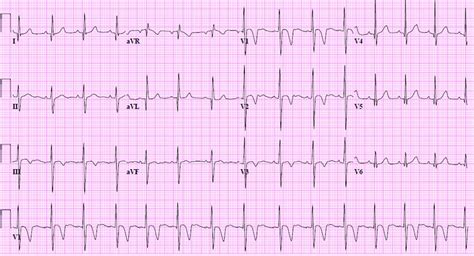 Transitional Av Canal Defect