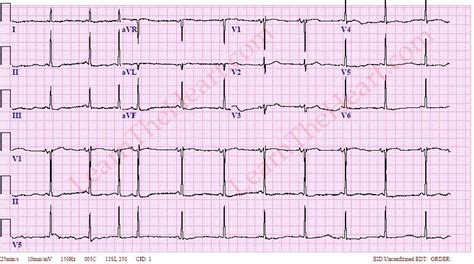 Lown Ganong Levine Lgl Ecg Example 1