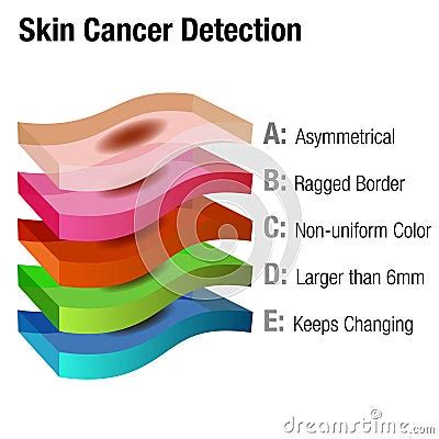 Skin Cancer Detection Cartoon Vector CartoonDealer Com 42476005
