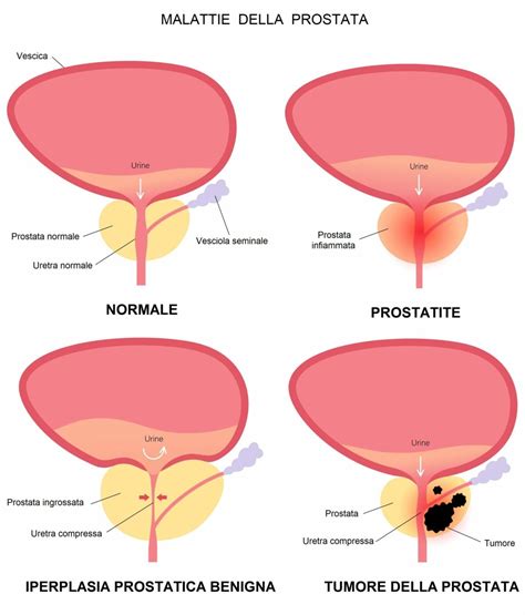 Biopsia Prostatica Artemisia Lab