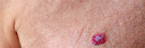 Comment Reconnaître Un Carcinome Basocellulaire Centre Chirurgie Dermatologique Paris