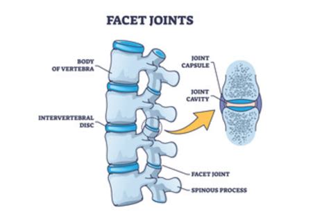 Understanding Facet Joint Syndrome Causes Symptoms More
