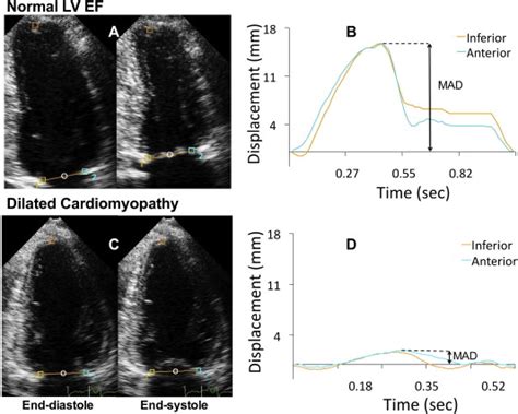 Rapid Estimation Of Left Ventricular Function Using Echocardiographic