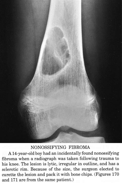 Pathology Outlines Nonossifying Fibroma