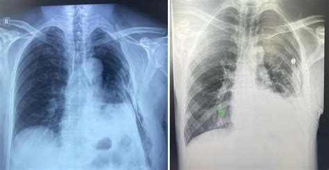 ГССҮТ ийнхөн Ховд Баян Өлгий аймагт очиж осолд орсон иргэдэд мэс засал хийв Hunnu Mn