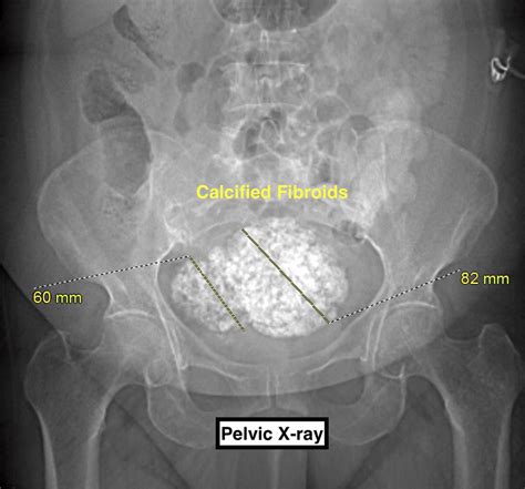 Effective Calcified Uterine Fibroid Treatment Insights