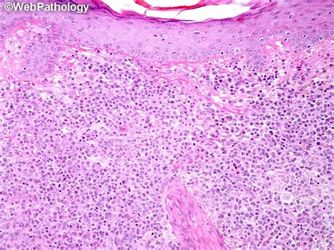 Myeloid Sarcoma Skin