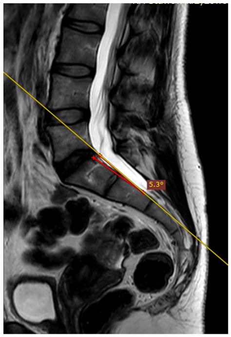 Performance Of Fully Automated Algorithm Detecting Bone Marrow Edema In Sacroiliac Joints