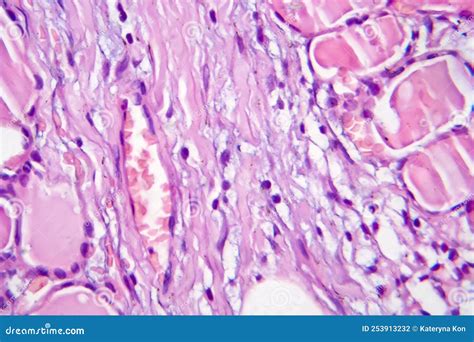 Fibrous Thyroiditis Light Micrograph Stock Image