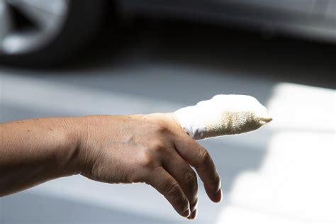 손가락 멀쩡하지만 잘라주세요” 스스로 장애인 되고자 하는 정신질환 대체 왜