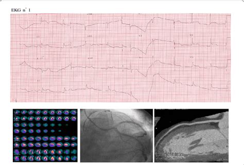 Left Myocardic Perfusion With Apical Inferior Mid Inferior And