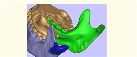 Virtual Condylar Fracture Reduction Download Scientific Diagram