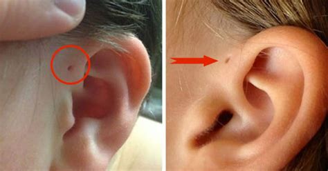This Is Why Some People Have Those Little Holes Above Their Ears