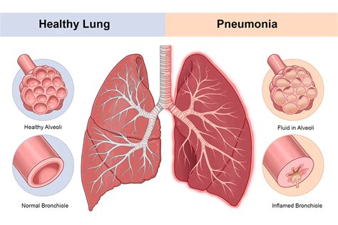 Opportunistic Etiological Agents Causing Lung Infections Emerging Need