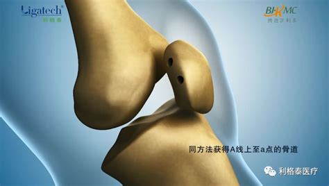 MPFL重建术的新选择 上海利格泰生物科技有限公司