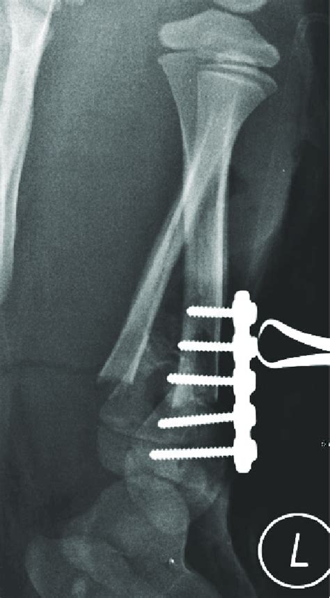 Immediate Postoperative Radiographs Reduction Of The Tibia Was Download Scientific Diagram