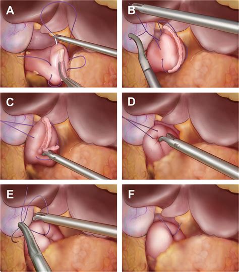 Reinforcement On Duodenal Stump Using Laparoscopic Single Purse String