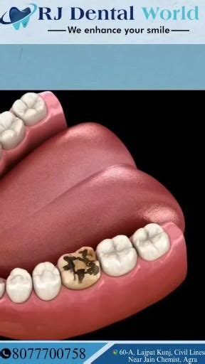 Crown Is Recommended For Severally Decayed Tooth To Conserve It Video