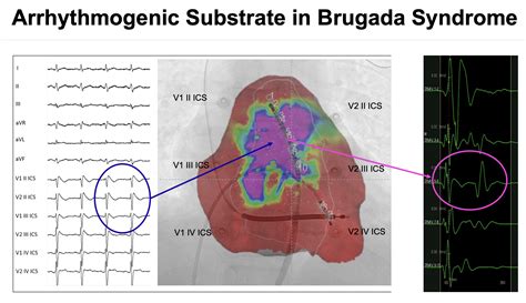 Brugada Syndrome Heart