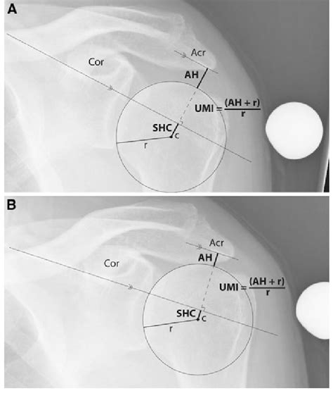 Subacromial Space