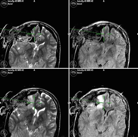 Brain Shift And Updated Intraoperative Navigation With Intraoperative Mri Radiology Key