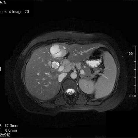 Extended Left Hemihepatectomy Specimen With The Tumor Within The Common Download Scientific