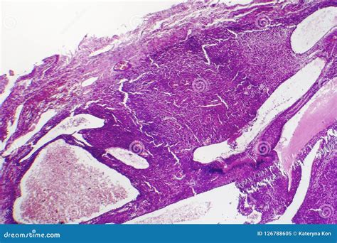 Fibrosarcoma Malignant Tumor Of Fibroblasts Stock Image Image Of Malignant Eosin 126788605