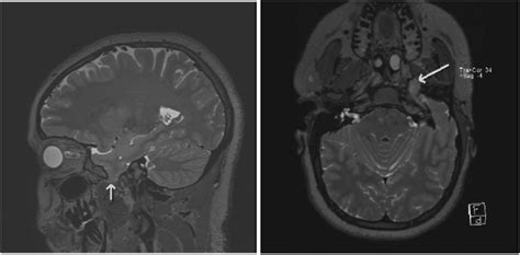 Axial And Sagittal T2 Space Images Show Encephalocele In Left Middle Download Scientific