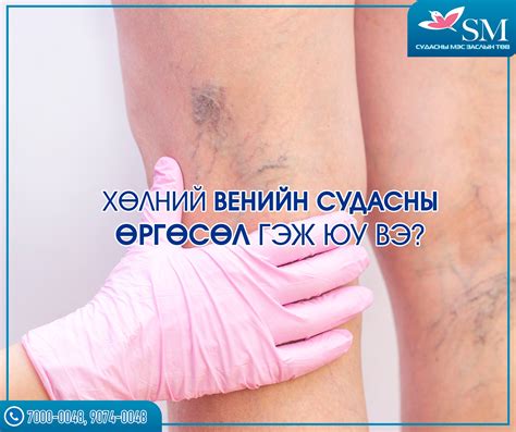 🚩Хөлийн Венийн судас буюу Sm Судасны мэс заслын төв