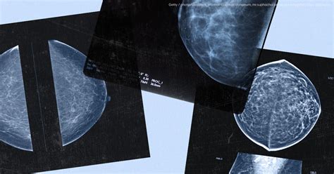 Are Ai Assisted Mammograms The Future Ps Health
