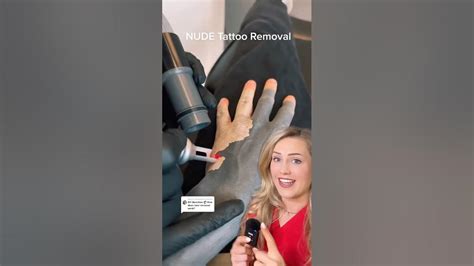 Tattoo Removal Explained Youtube