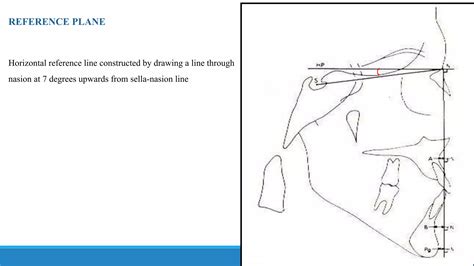 Cogs Burstone Analysis For Orthognathic Surgery Pptx