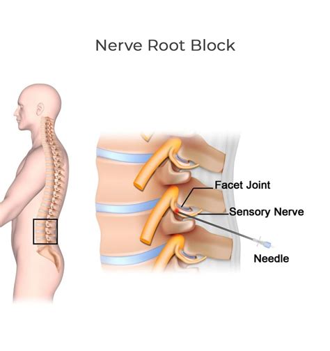 Nerve Root Block Treatment In Delhi Dr Saurabh Kapoor