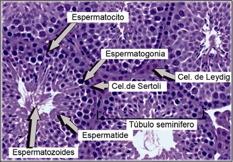 Histologia Testicular Rotulada Tumor Testicular Bilateral Sincrónico
