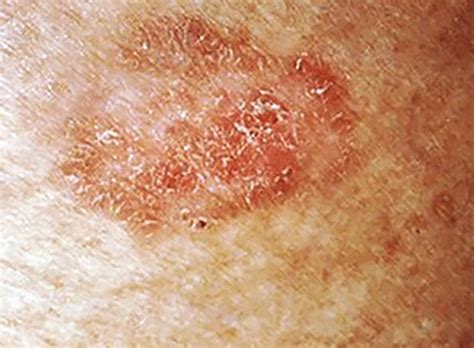 Squamous Cell Skin Cancer Early Stages My Xxx Hot Girl
