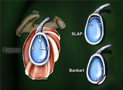 Bankart Lesion Vs Slap Tear