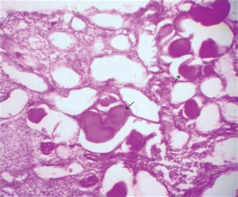 Collapsing Glomerulopathy In An Hiv Positive Patient In A Low Incidence Belt Indian Journal Of